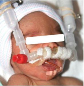 CPAP for NICU or Babies with RDS | Bubble CPAP Institute