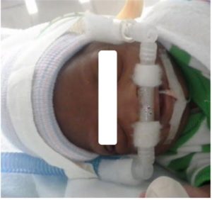 Dexamethasone & BCPAP for infants | Bubble CPAP Institute